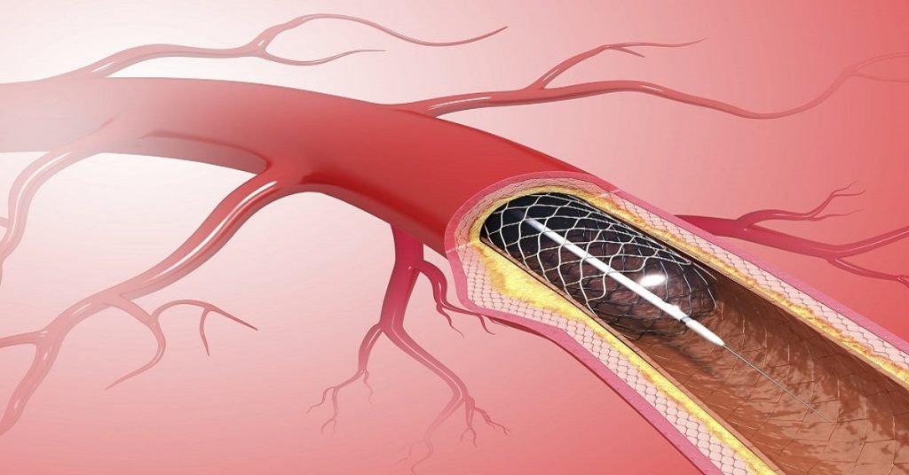 What Is The Purpose Of A Coronary Stent For Heart Problem? - Plus100years